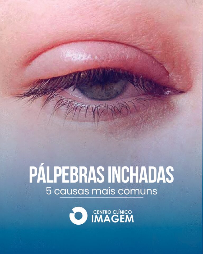 Pálpebras Inchadas: 5 causas mais comuns - Centro Clínico Imagem