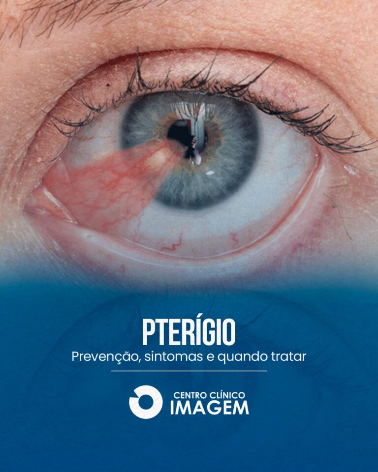 Pterígio: prevenção, sintomas e quando tratar - Centro Clínico Imagem